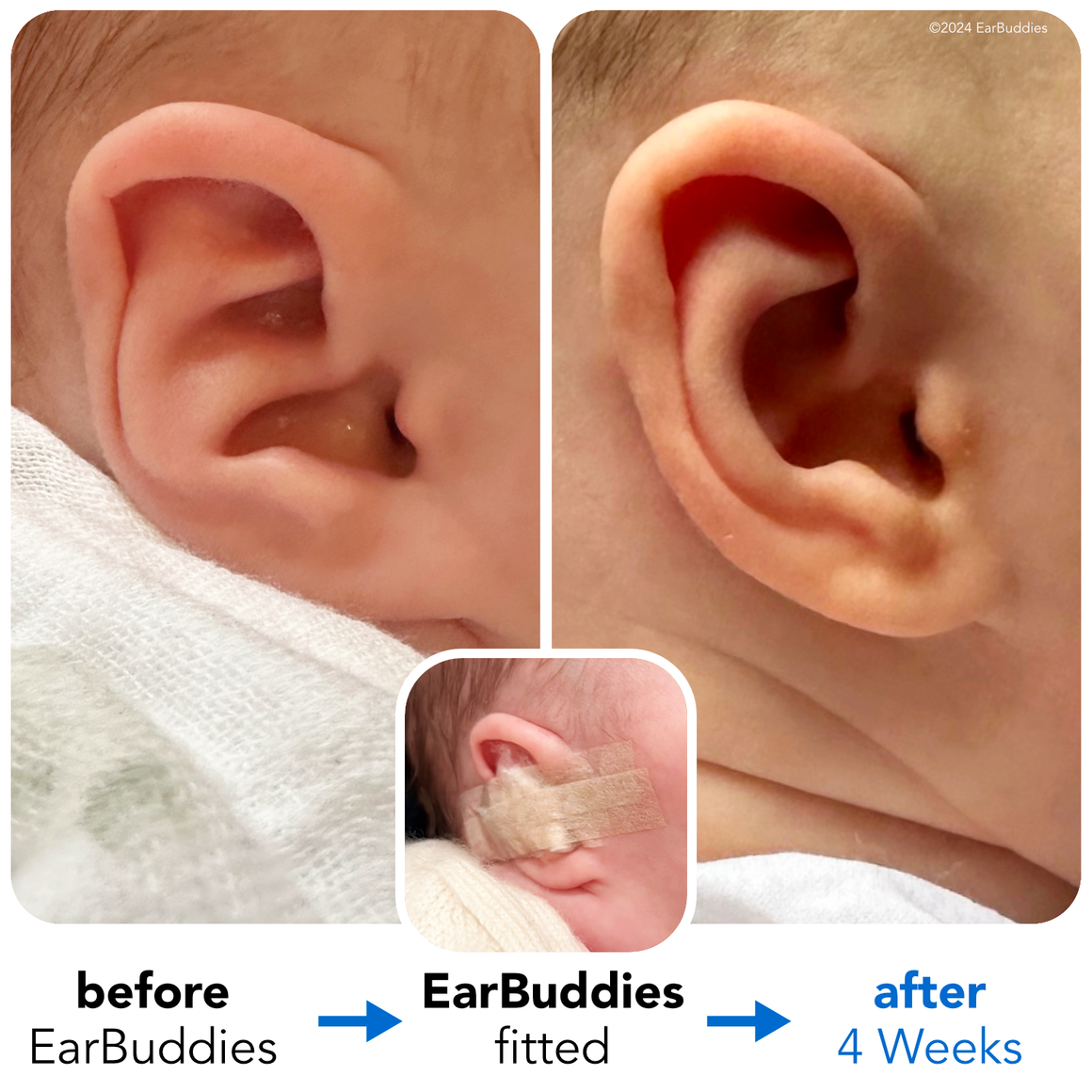 Babys Ears starting to Stick Out or Fold Over? | EarBuddies™