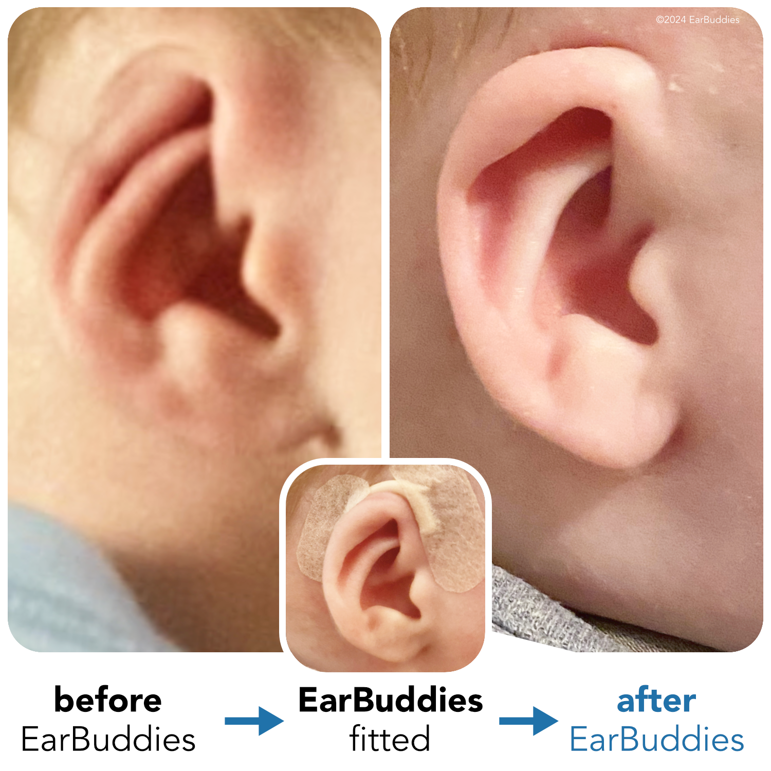 EarBuddies | Permanent Solution to Stick-Out Ears & Ear Deformities