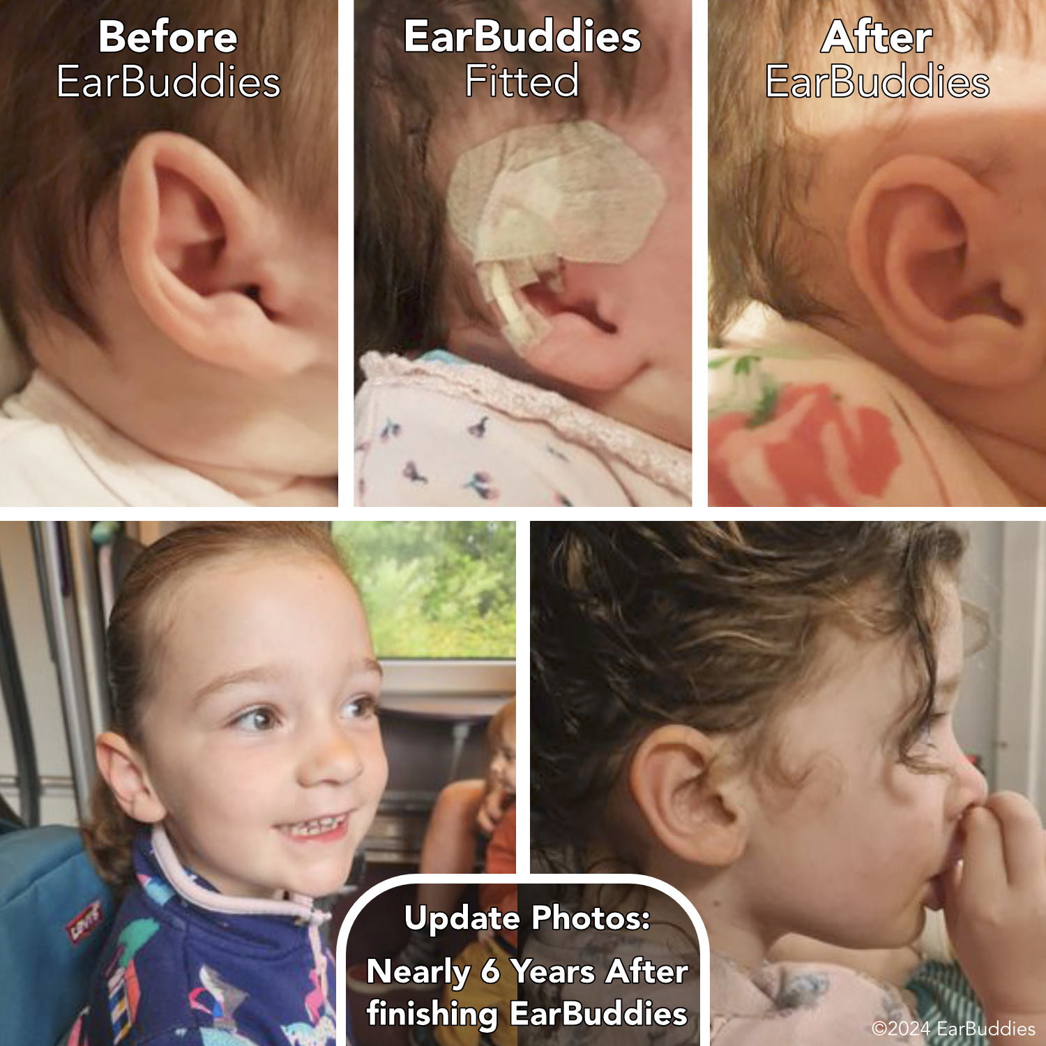 EarBuddies | Permanent Solution to Stick-Out Ears & Ear Deformities