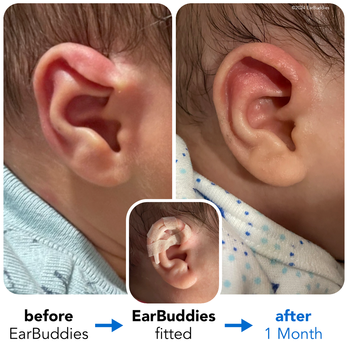 Babys Ears starting to Stick Out or Fold Over? | EarBuddies™